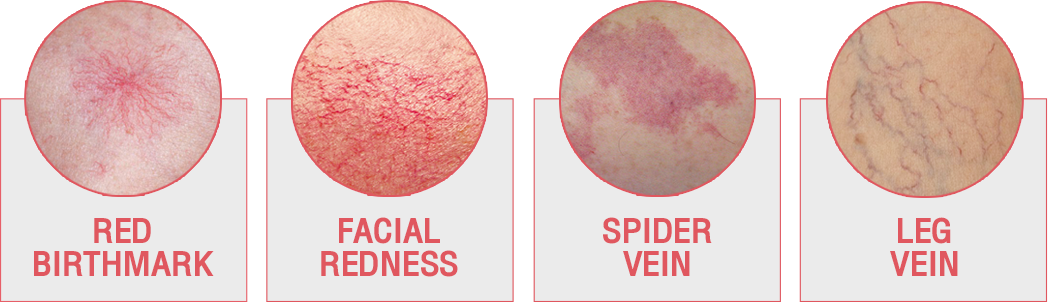 Facial Redness (Rosacea), Red Birthmarks, Spider and Leg Veins - BSL Clinic