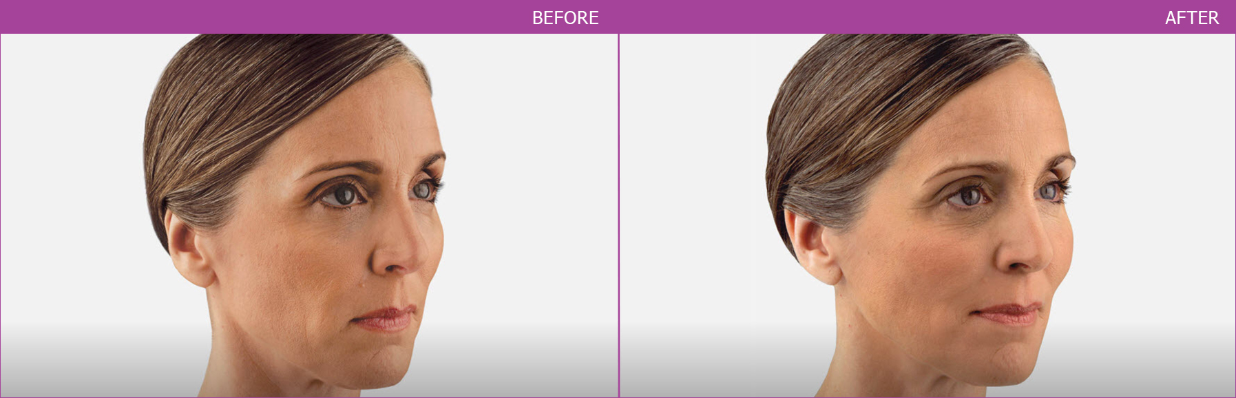 HA Filler (USA) - Bangkok Aesthetic Clinic