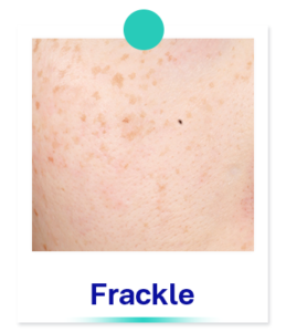 Freckles, Sun and Dark Spots - Bangkok Aesthetic Clinic
