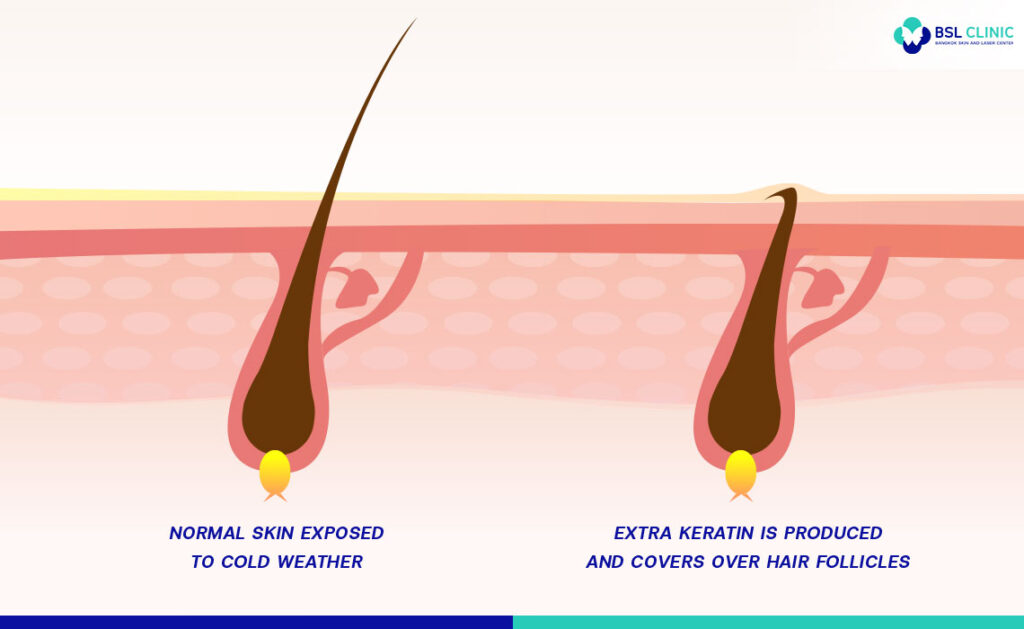 Effective Keratosis Pilaris Laser Treatment at BSL Clinic