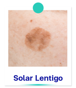 Freckles, Sun and Dark Spots - Bangkok Aesthetic Clinic