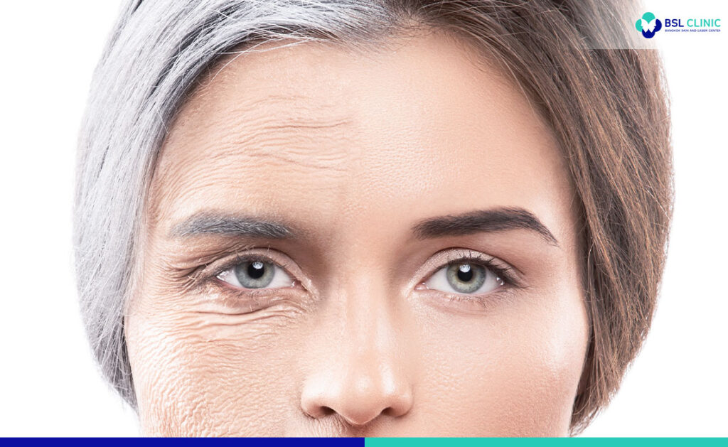 Face Wrinkle Reduction - Bangkok Aesthetic Clinic