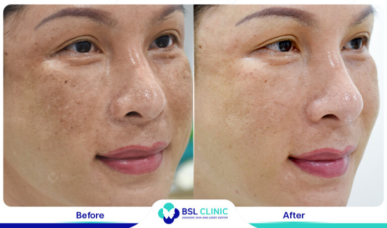 Melasma Treatment Results: Before & After at BSL Clinic