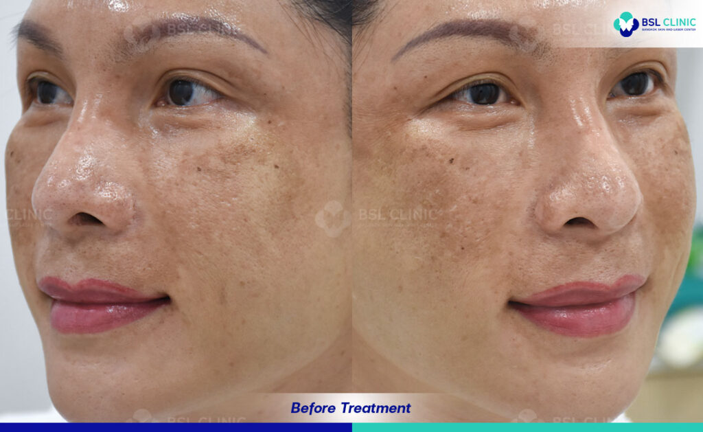 Transform Your Skin: Break Free from Melasma (Sun Spot)