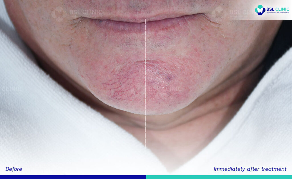 Facial Redness (Rosacea), Red Birthmarks, Spider and Leg Veins - BSL Clinic