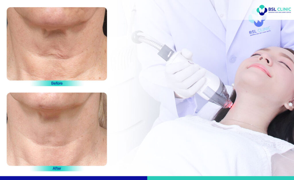 Neck lifting tightening and wrinkle removal without surgery.