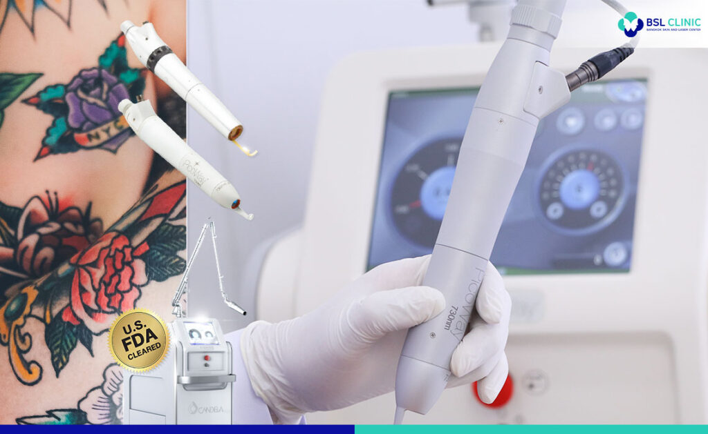 PicoWay Laser Program: Gently Fades Unwanted Tattoos Away