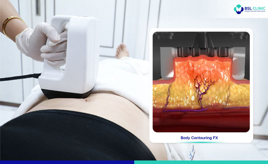 Fat Removal - BSL Clinic - Bangkok Aesthetic Clinic
