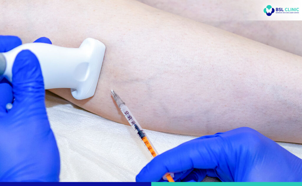 Sclerotherapy: A Treatment to Help Reduce Spider Veins