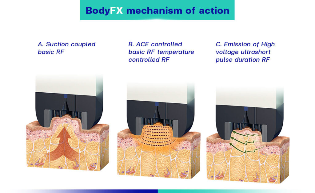 Body Contouring BodyFX - Bangkok Aesthetic Clinic