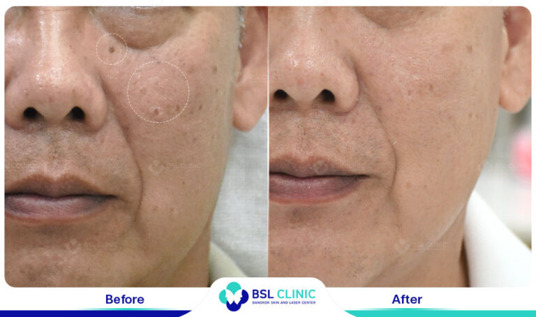 CO2 Laser Treatment for Skin Renewal | Bangkok Aesthetic