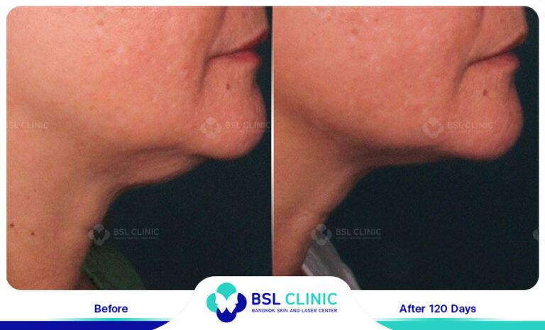 Enhance Your Look with Ultherapy Program: Non-Invasive Lift