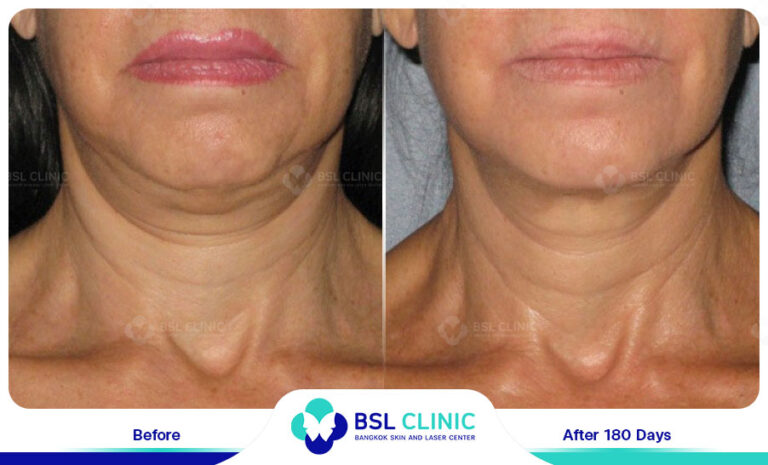 Enhance Your Look with Ultherapy Program: Non-Invasive Lift