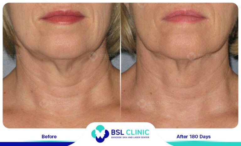Enhance Your Look with Ultherapy Program: Non-Invasive Lift