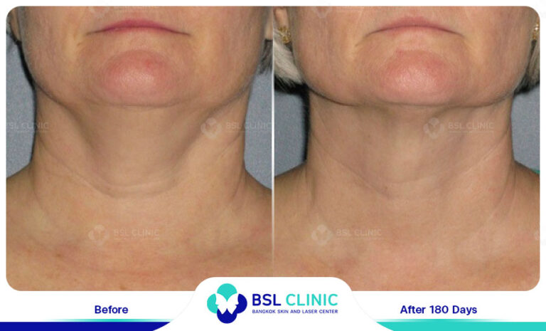 Enhance Your Look with Ultherapy Program: Non-Invasive Lift