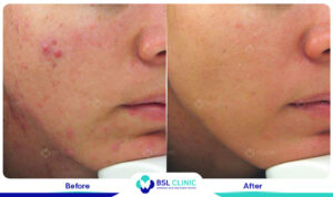 Fraxel Dual Laser | Skin Resurfacing and Rejuvenating