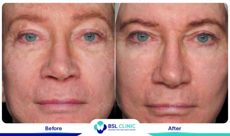 Fraxel Dual Laser | Skin Resurfacing and Rejuvenating