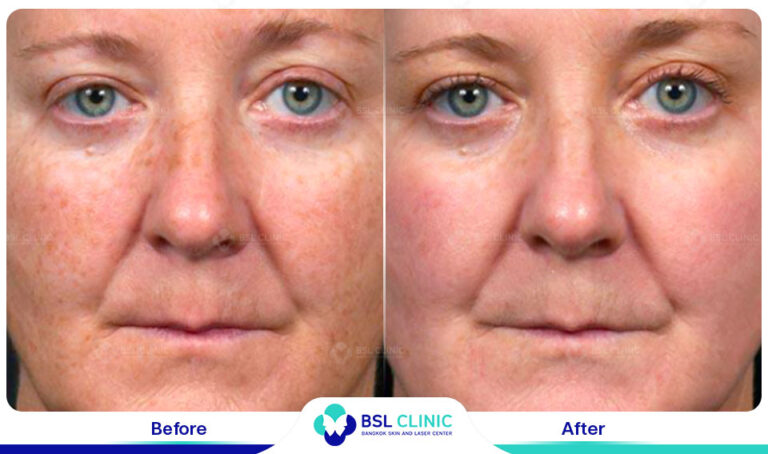 Fraxel Dual Laser | Skin Resurfacing and Rejuvenating