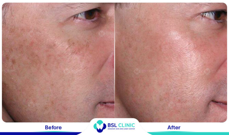 Fraxel Dual Laser | Skin Resurfacing and Rejuvenating