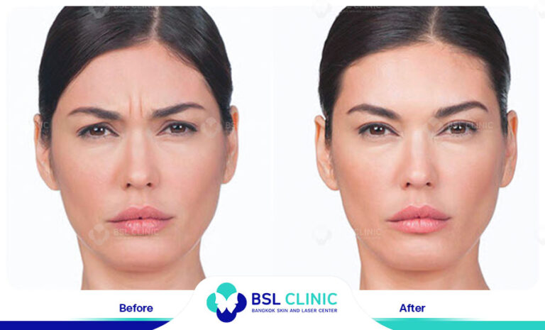 Refined Wrinkle-Relaxing Injection: A Consideration for Care