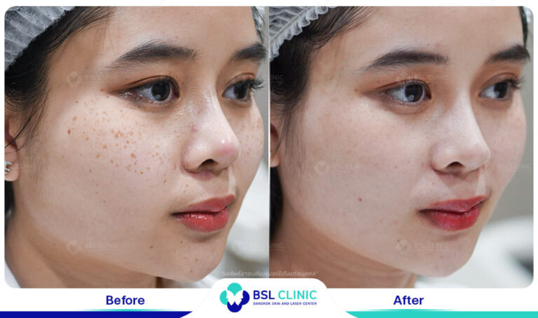 Freckle Treatments: Real Results with Before & After Photos