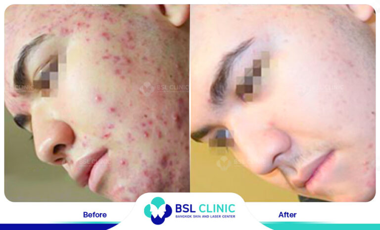 Fractora program: Treatment Supporting Skin Revitalization