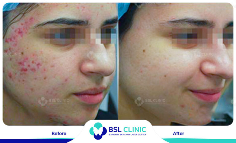 Fractora program: Treatment Supporting Skin Revitalization