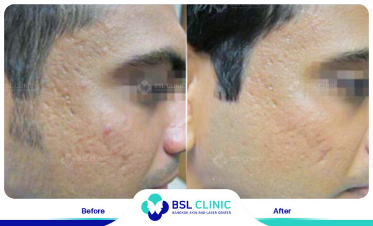 Fractora program: Treatment Supporting Skin Revitalization