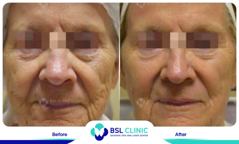 Fractora program: Treatment Supporting Skin Revitalization