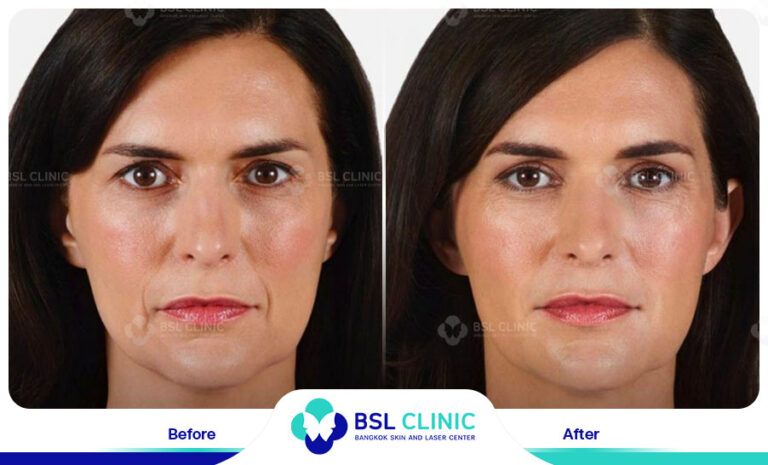 Rejuvenate Skin with HA Filler Program – Discover the Glow!