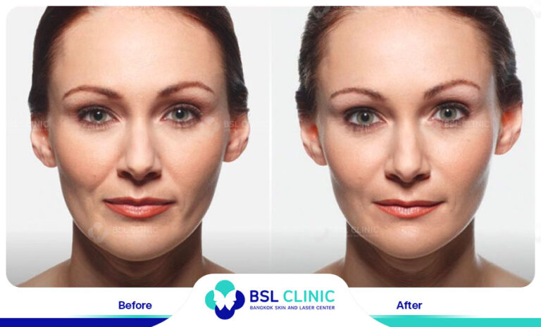 Rejuvenate Skin with HA Filler Program – Discover the Glow!