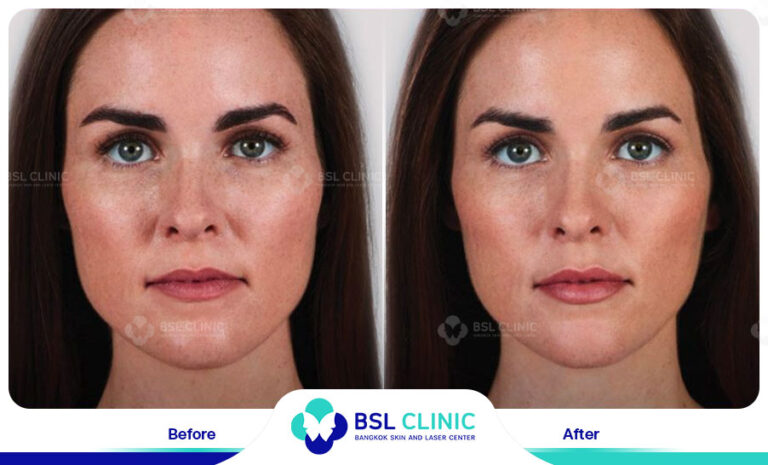 Rejuvenate Skin with HA Filler Program – Discover the Glow!