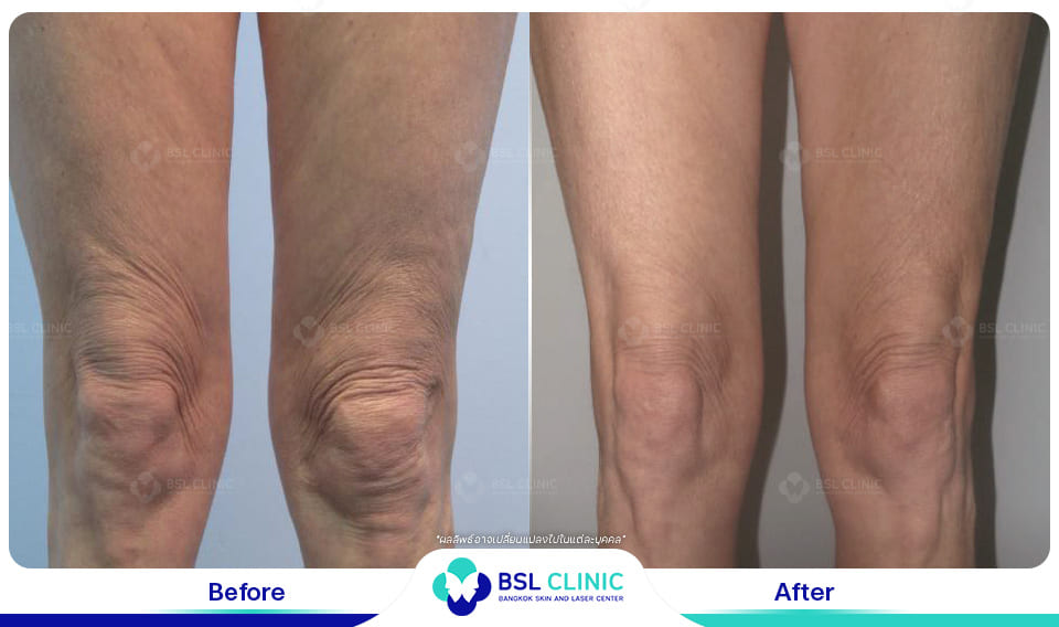 Real Results from Body Reshaping and Weight Loss Journey