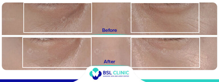 Rejuran Program: Effective Skin Revitalization in Bangkok