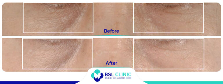 Rejuran Program: Effective Skin Revitalization in Bangkok