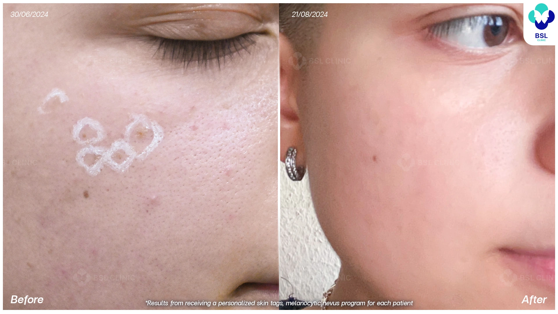 Skin Tag Treatment: A Gentle, Quick Way to Clearer Skin