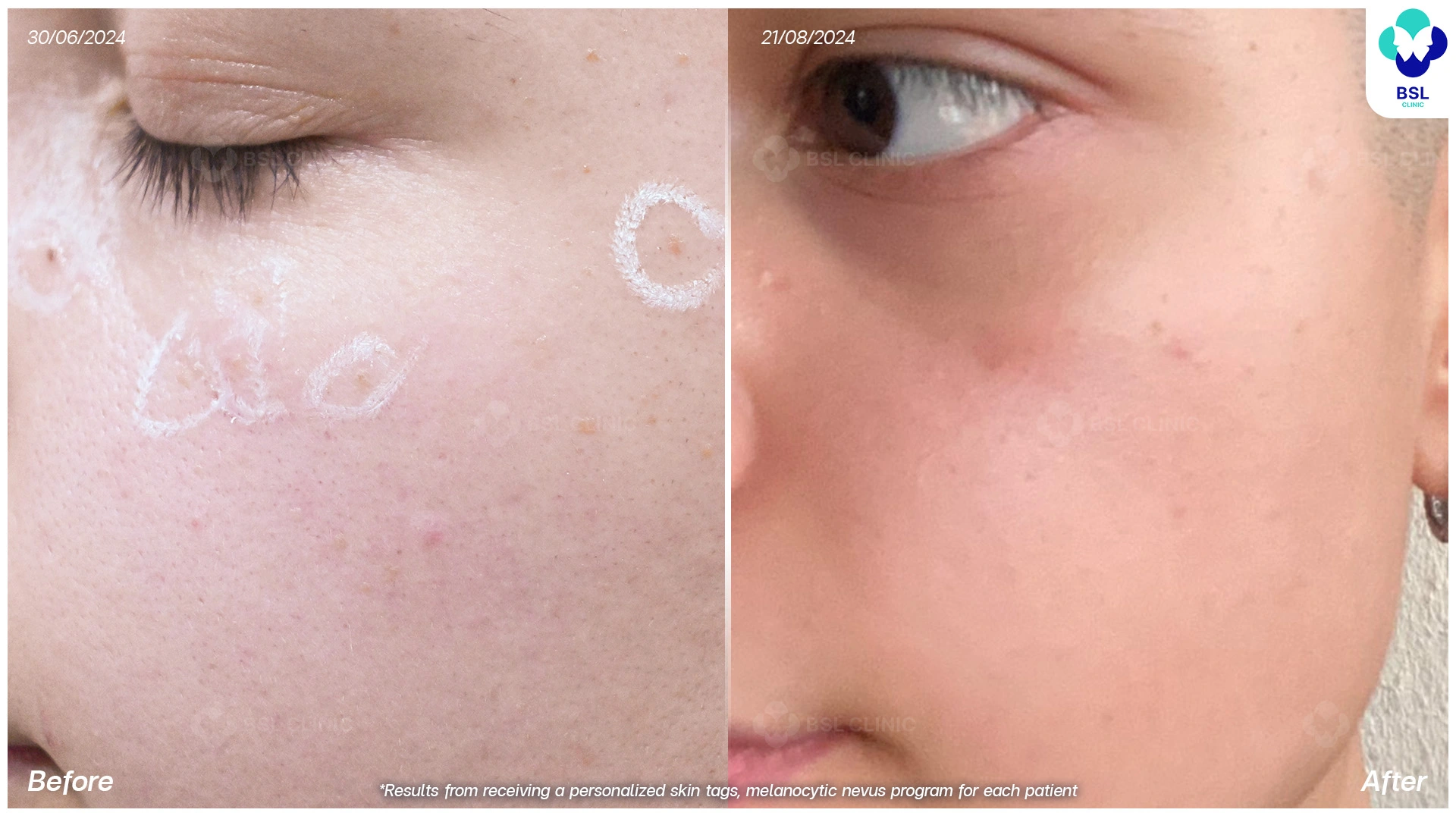 Skin Tag Treatment: A Gentle, Quick Way to Clearer Skin