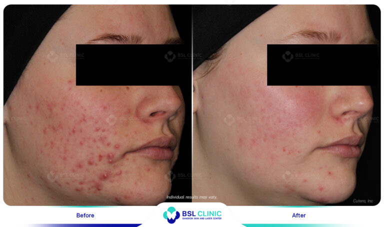 Versatile AviClear Program | A Consideration for Acne Care