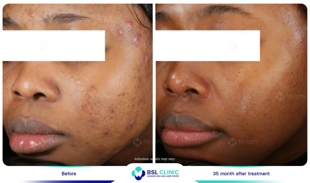 Accure Laser Program | An Effective Option for Acne Care