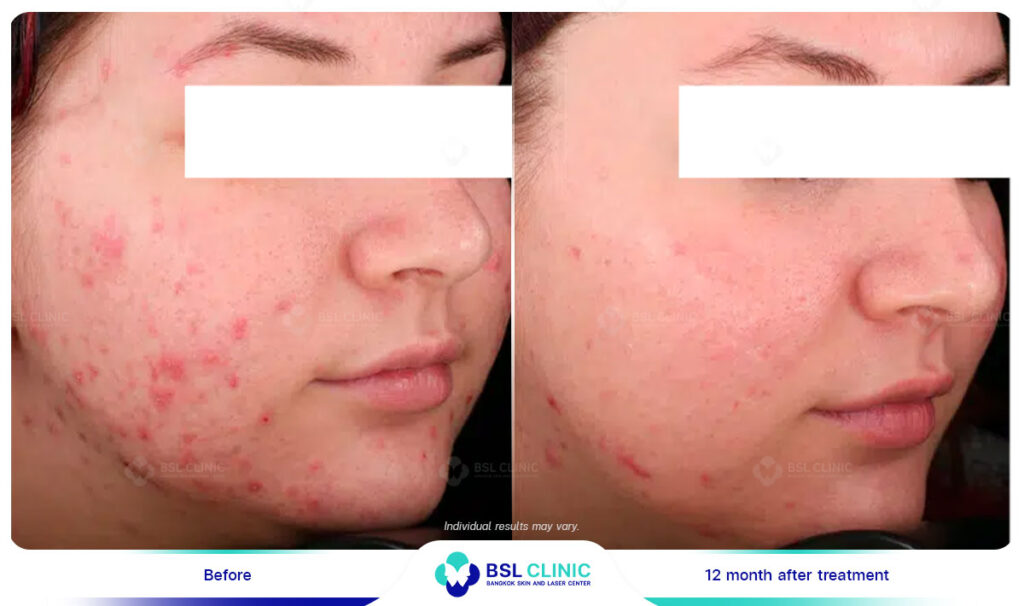 Accure Laser Program | An Effective Option for Acne Care