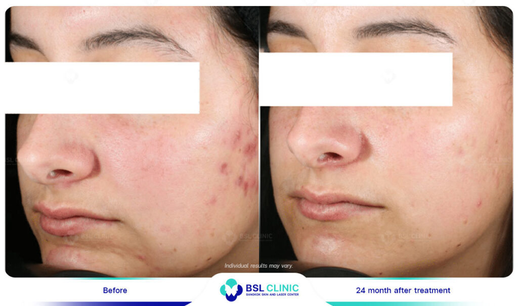 Accure Laser Program | An Effective Option for Acne Care