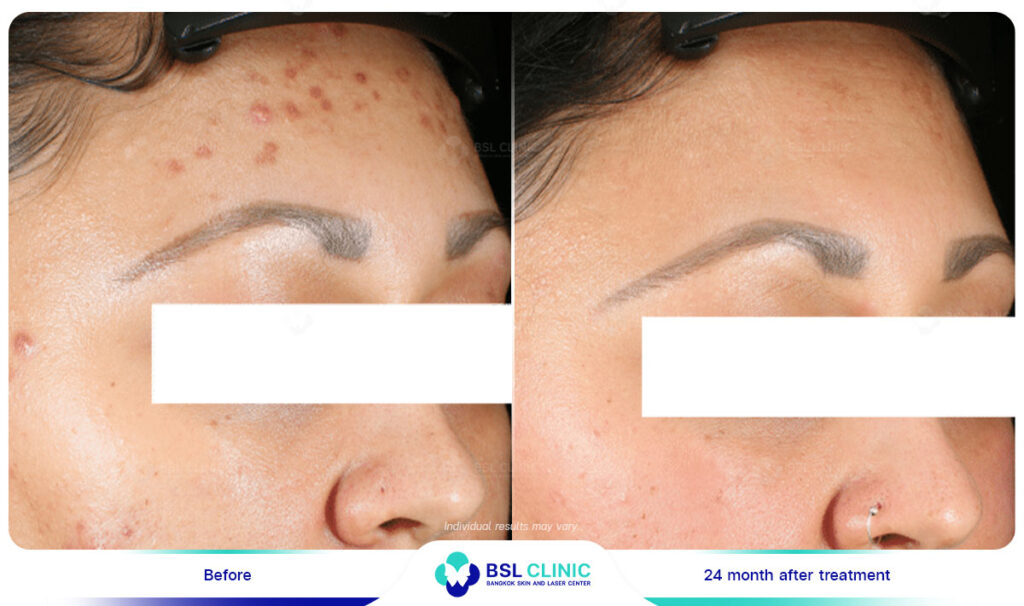 Accure Laser Program | An Effective Option for Acne Care