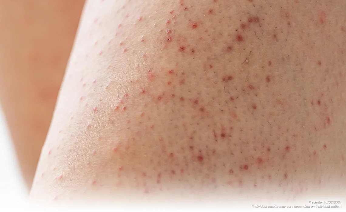 Effective Keratosis Pilaris Laser Treatment at BSL Clinic