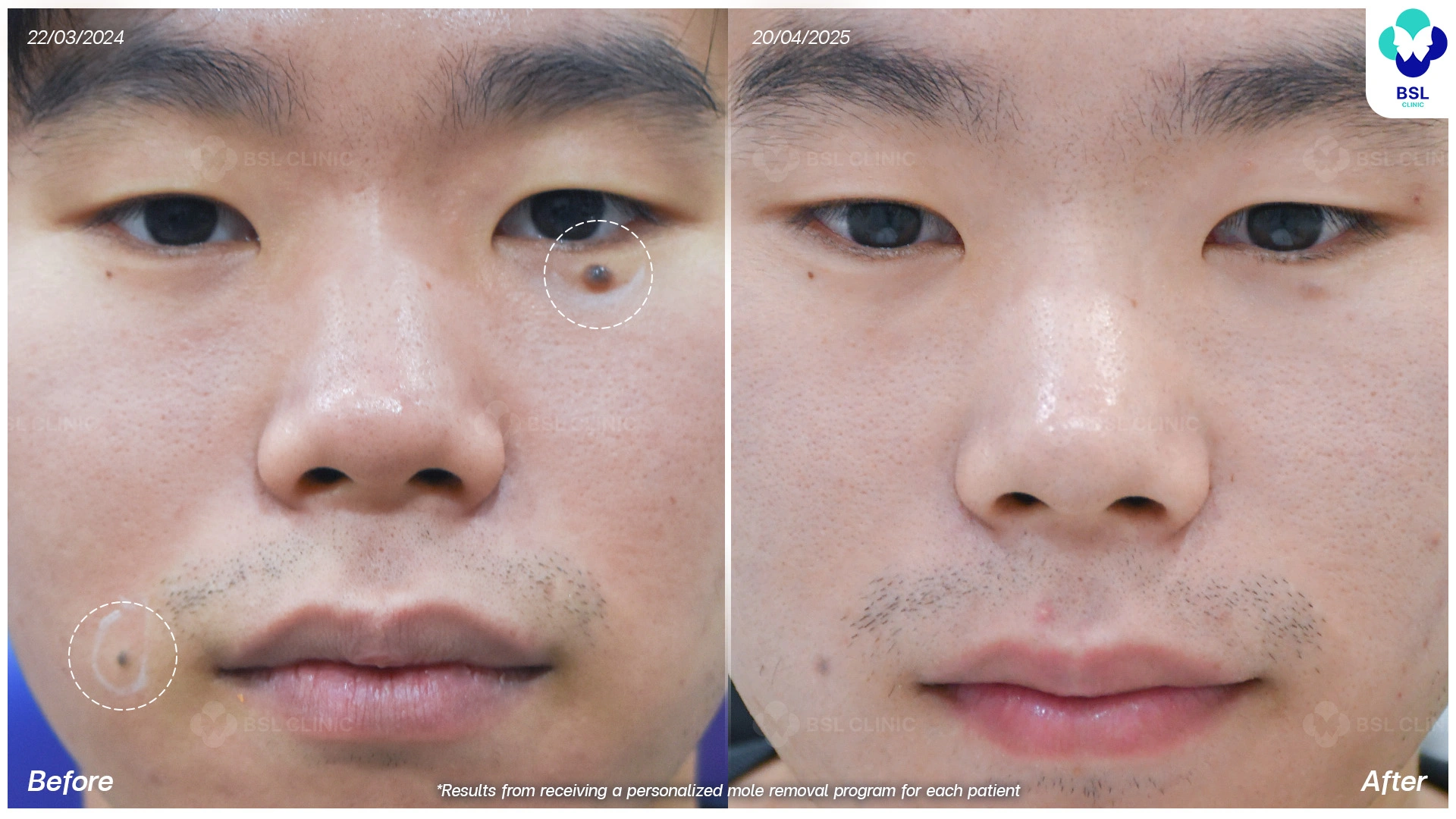 Skin Tag Treatment: A Gentle, Quick Way to Clearer Skin