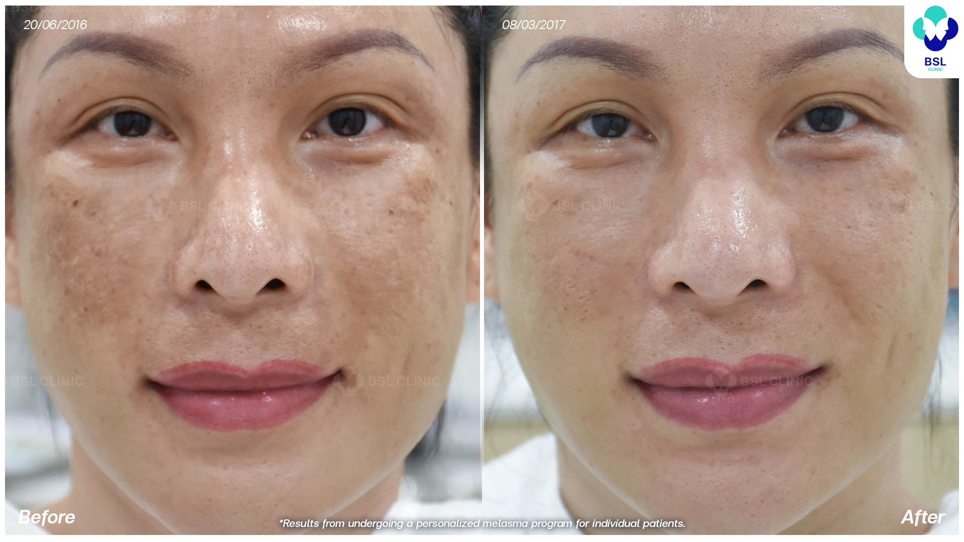 Melasma Treatment Results: Before & After at BSL Clinic