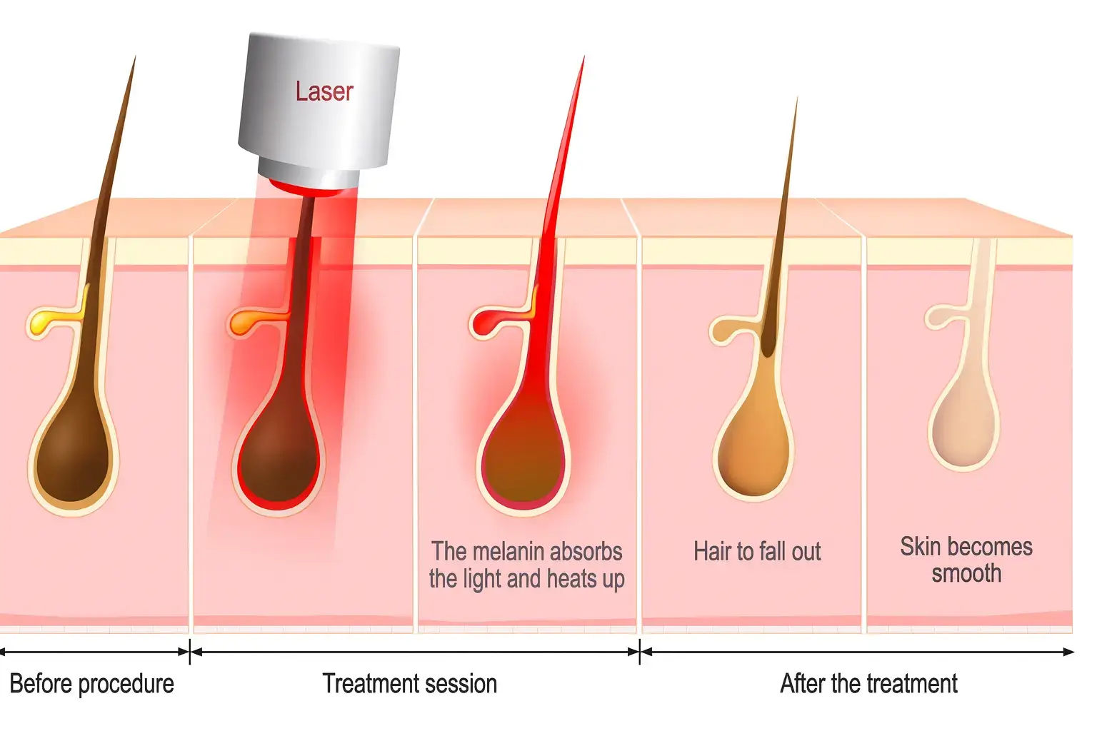 Laser Hair Removal: Effective & Gentle Hair Reduction