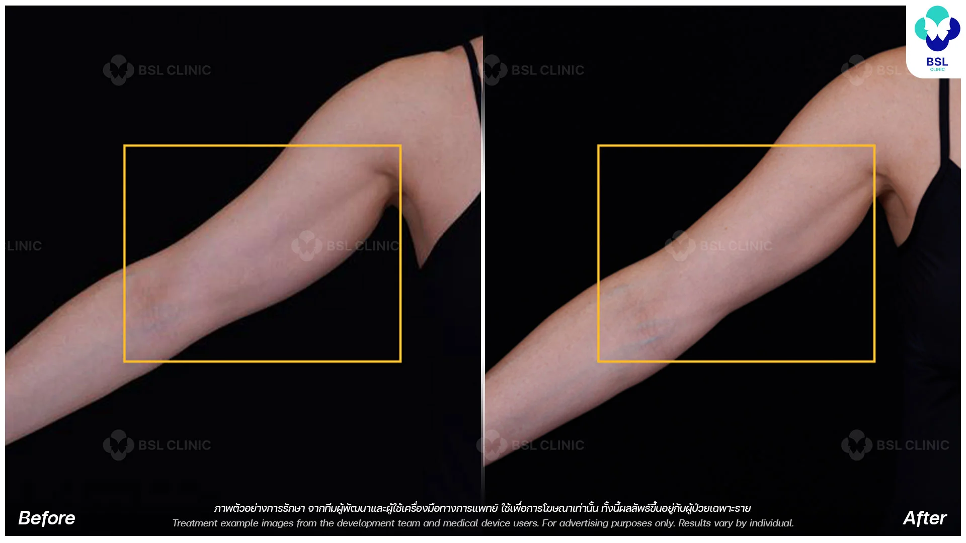Ultherapy Prime Program – Subtle Lift, Remarkable You