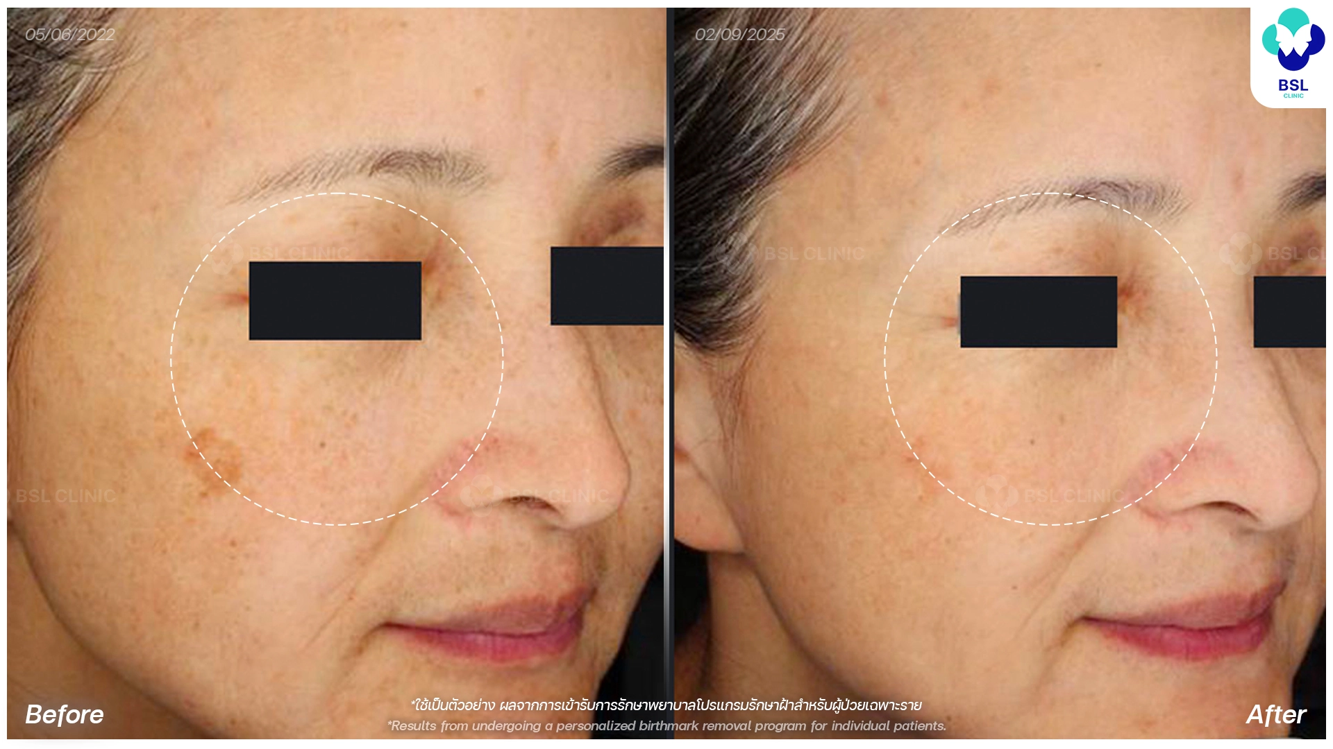 Reveal PicoWay Laser Program for Dark Spots & Acne Scars