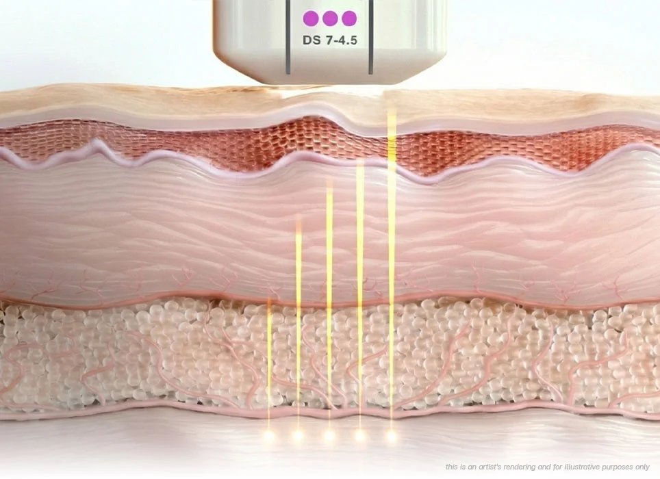 Ultherapy Prime Program – Subtle Lift, Remarkable You